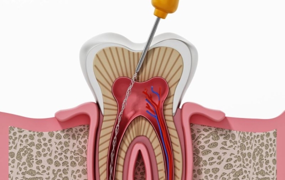 Endodoncia en Valencia | Clínica Jaime I Catarroja - Valencia